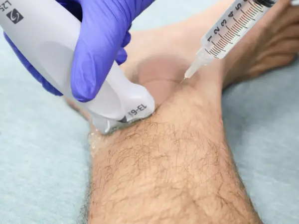 Posterior Tibial Nerve Block - Emergency Medicine Training