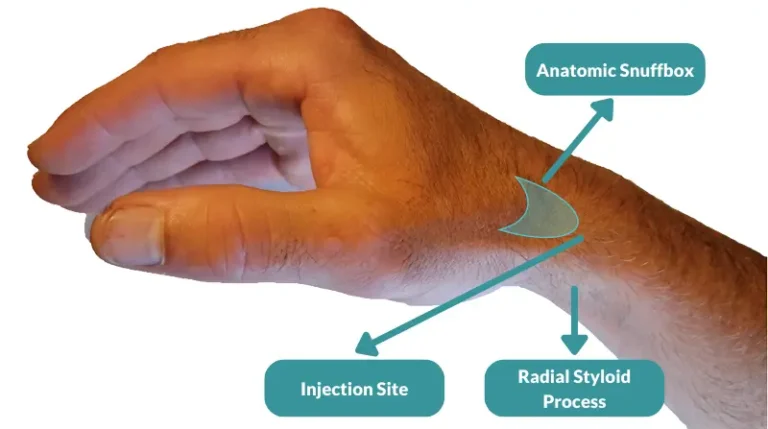 Radial Nerve Block - Emergency Medicine Training